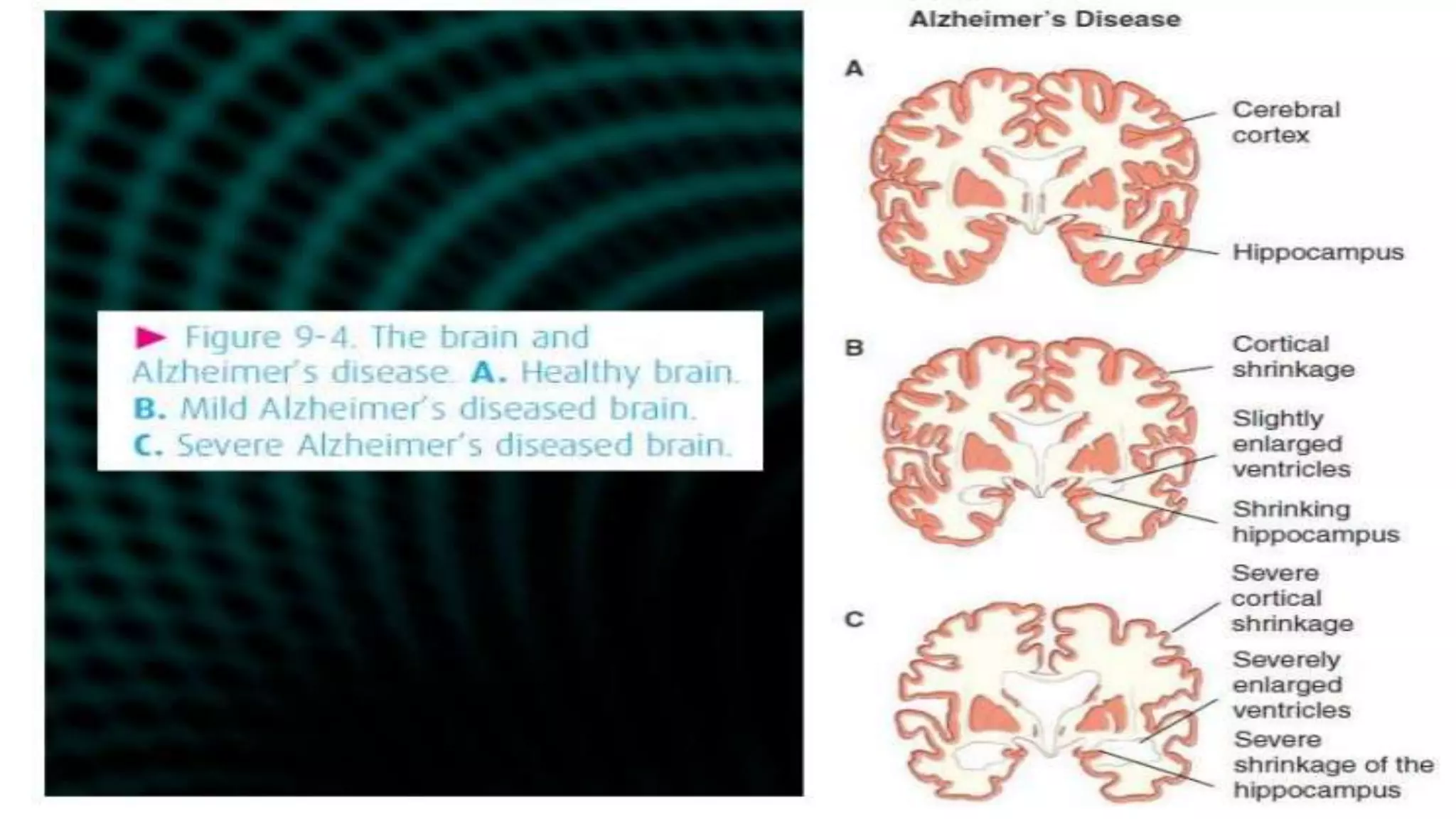 Alzheimer’s disease ppt | PPTX