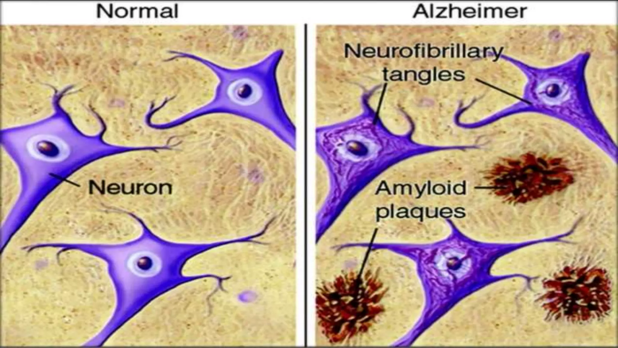 Alzheimer’s disease ppt | PPTX