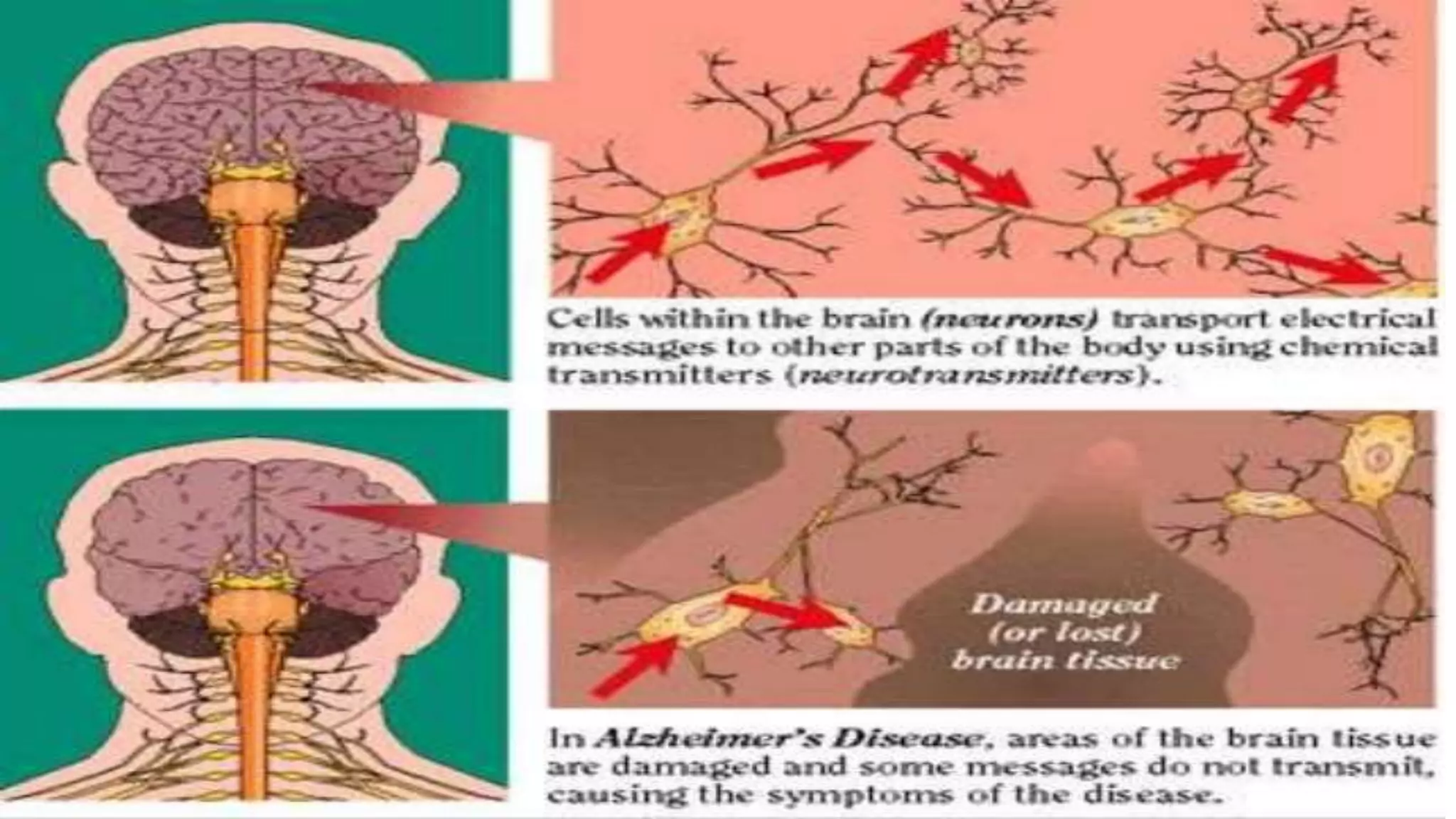 Alzheimer’s disease ppt | PPTX