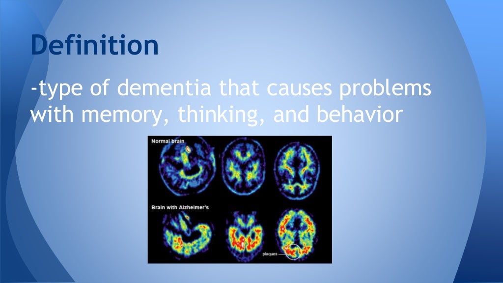 Alzheimer's Disease Presentation