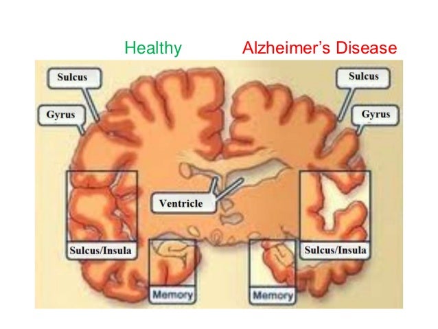 Pathophysiology: Alzheimer's Disease