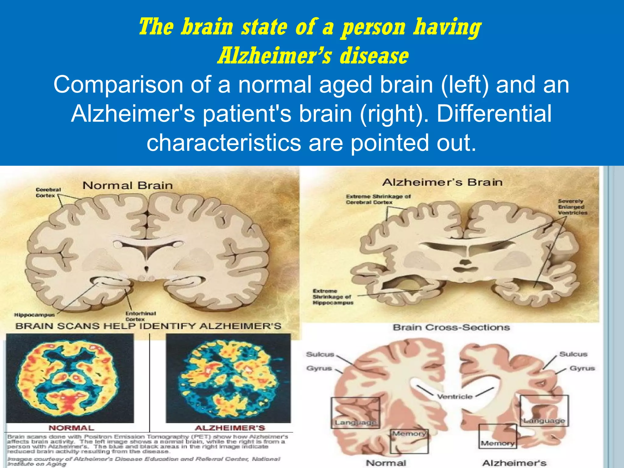 Alzheimers presentation........... | PPT