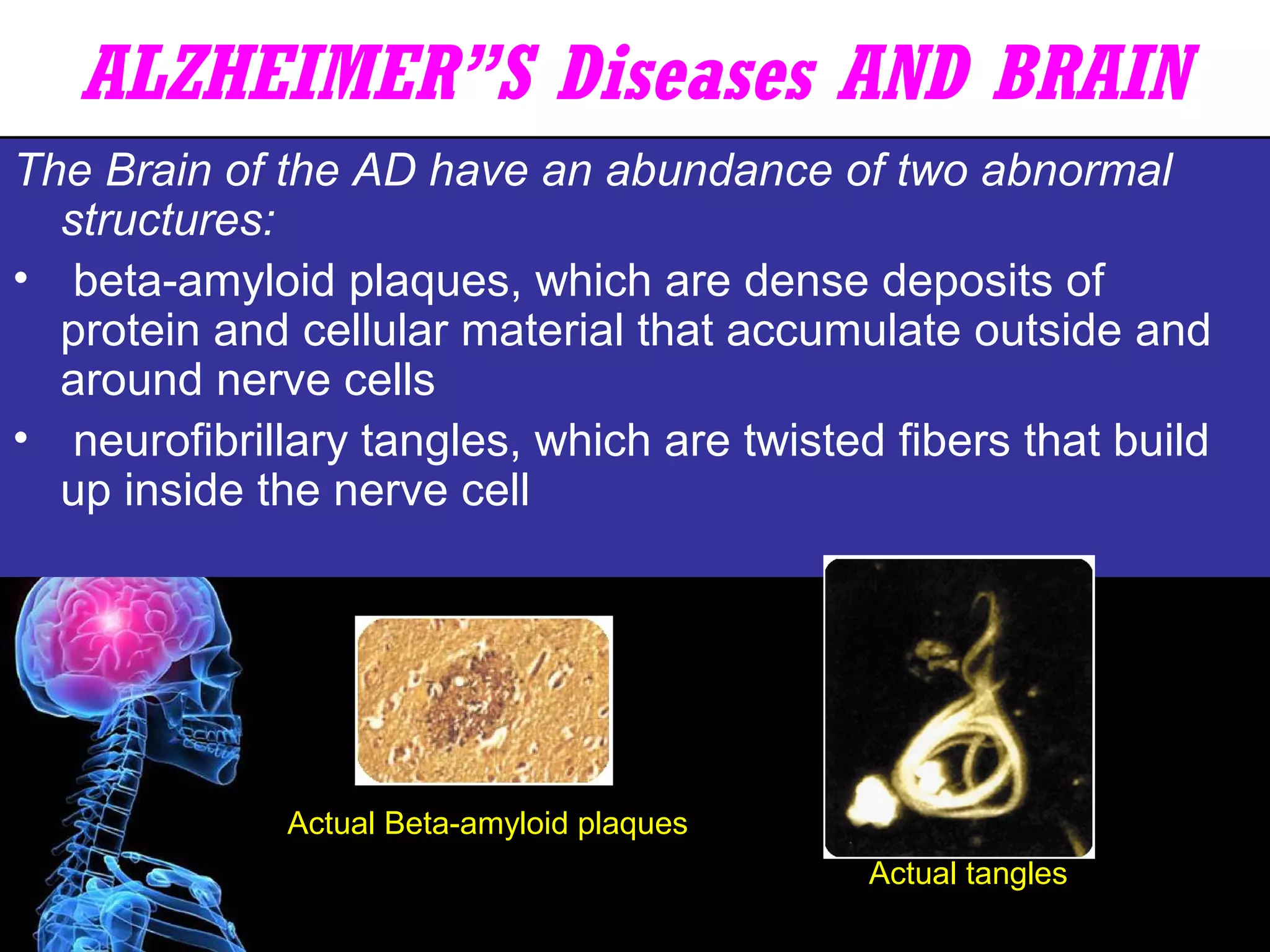 Alzheimers presentation........... | PPT
