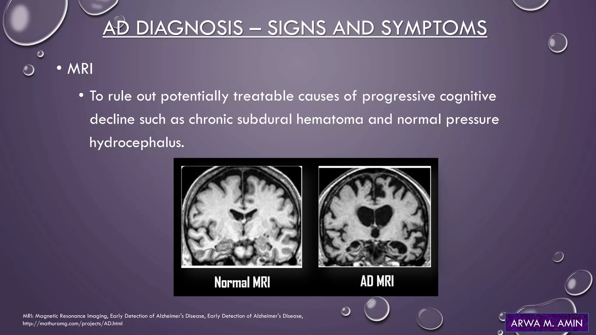 Alzheimer's Disease (AD) | PDF