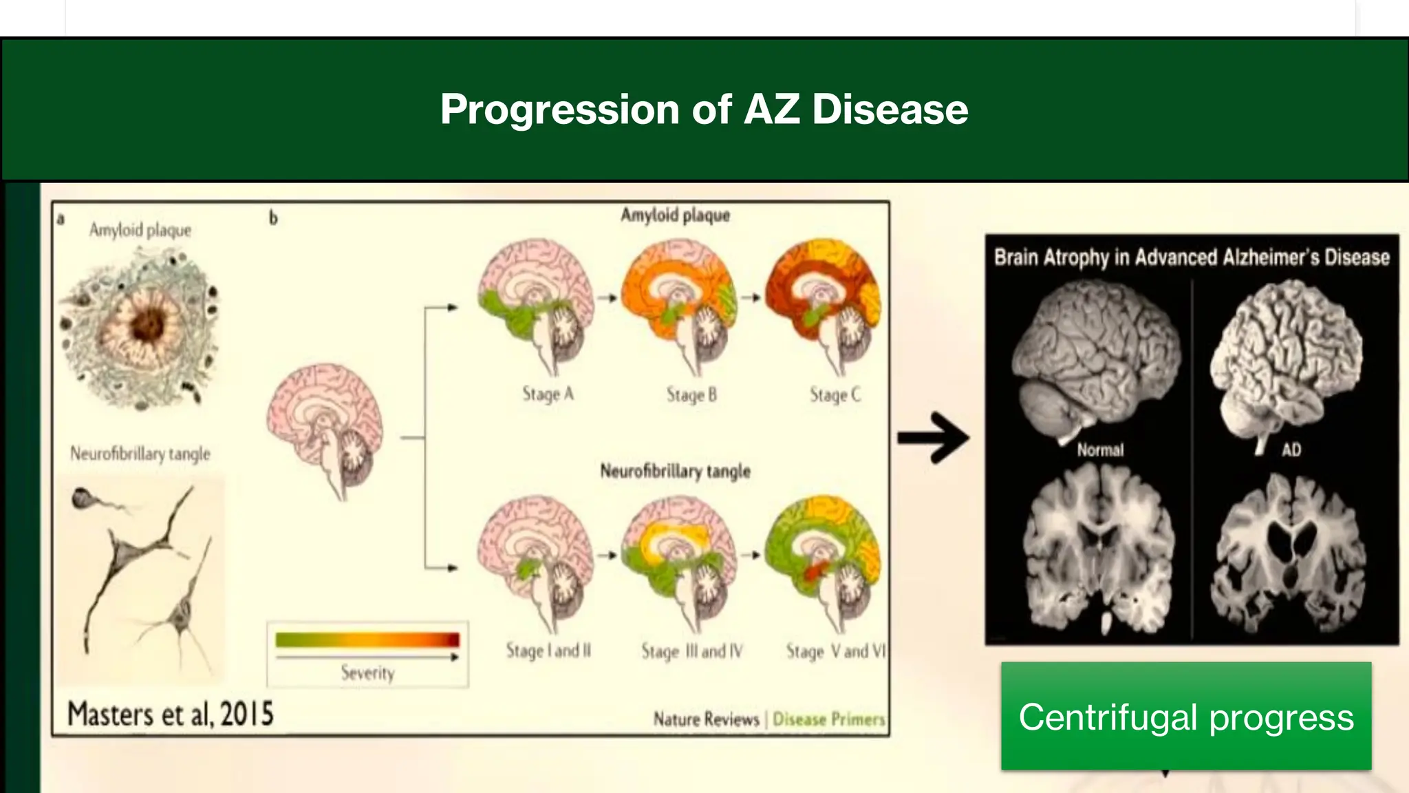 alzhimer disease introduction, treatment and symptoms | PDF