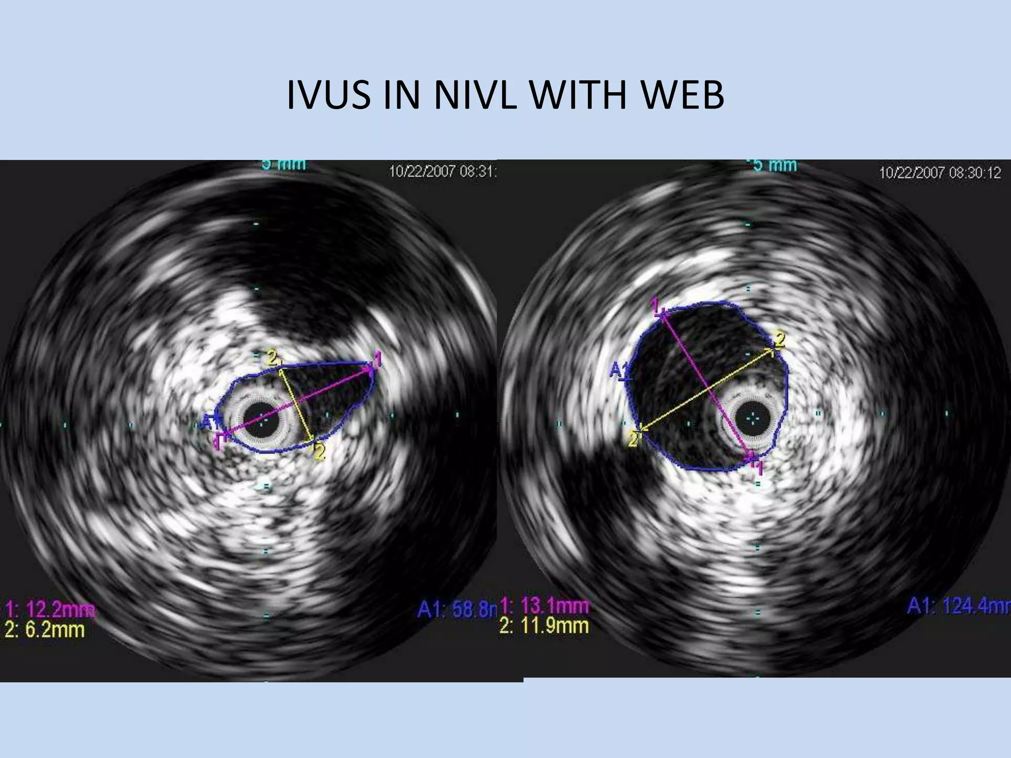 Non-Thrombotic Iliac Vein Lesions: Permissive Role in CVD Pathogenicity ...