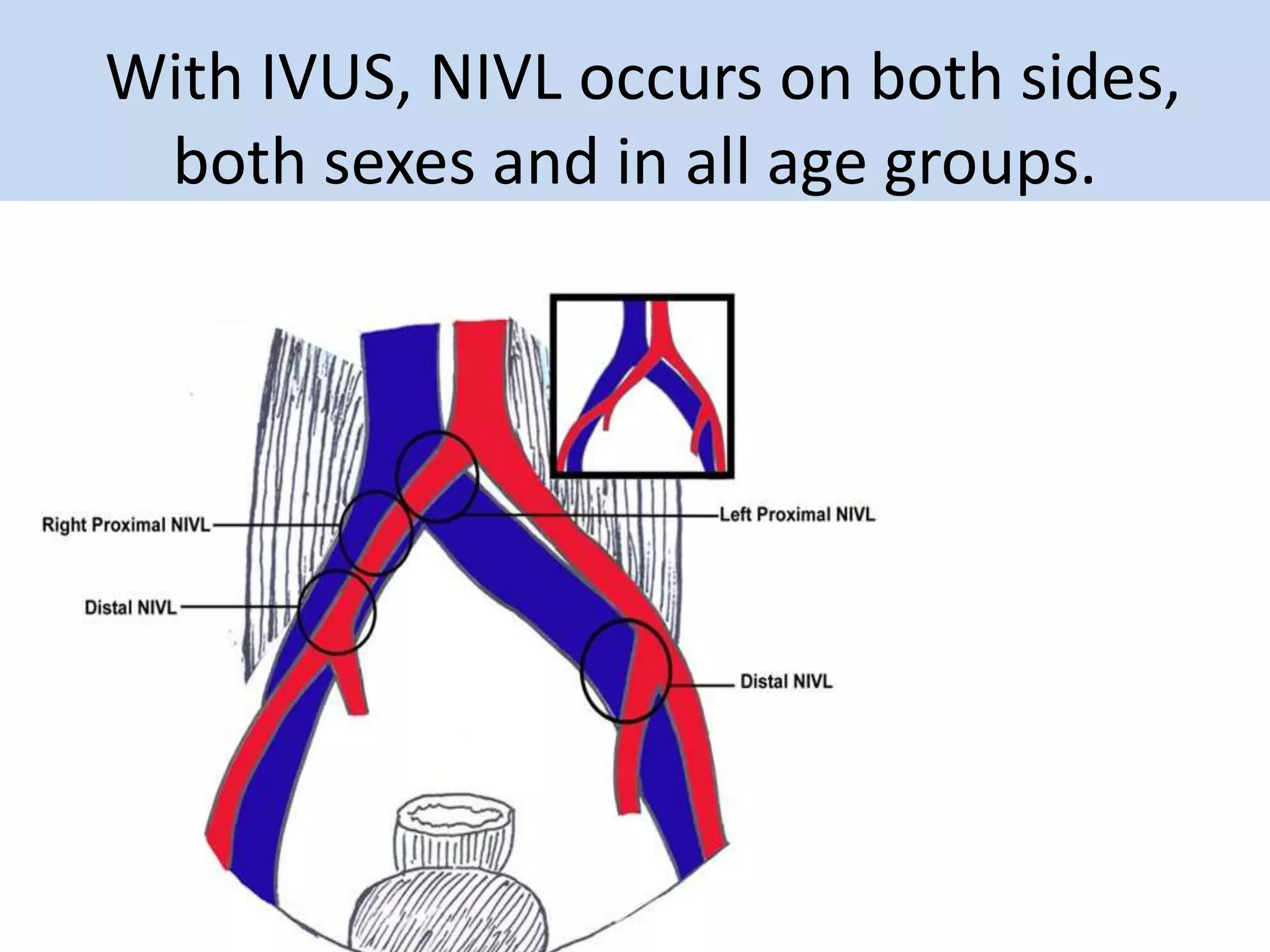 Non-Thrombotic Iliac Vein Lesions: Permissive Role in CVD Pathogenicity ...
