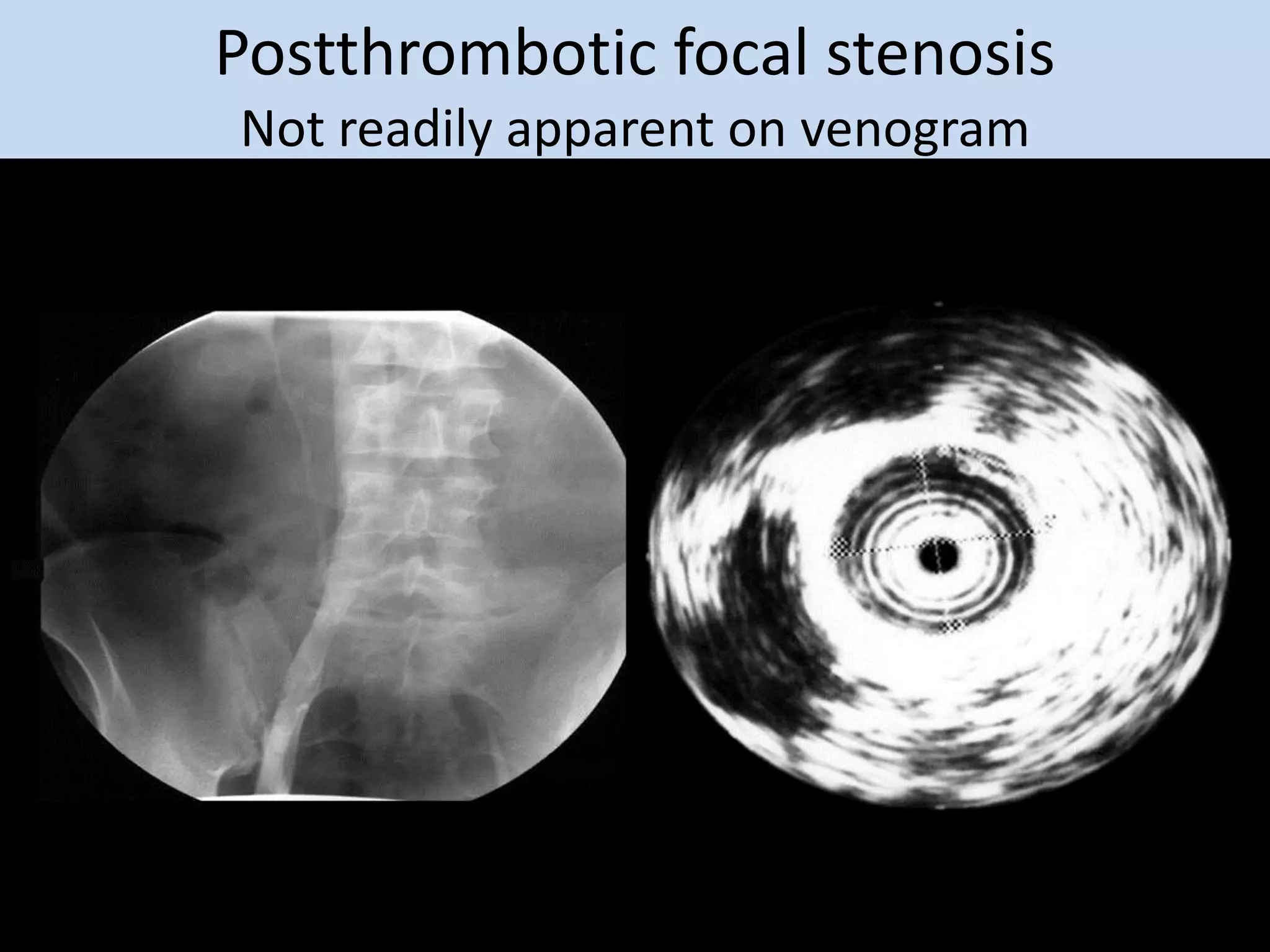 Non-Thrombotic Iliac Vein Lesions: Permissive Role in CVD Pathogenicity ...