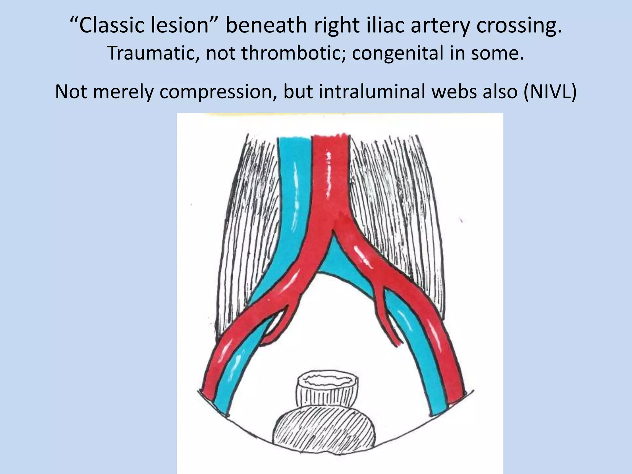 Non-Thrombotic Iliac Vein Lesions: Permissive Role in CVD Pathogenicity ...