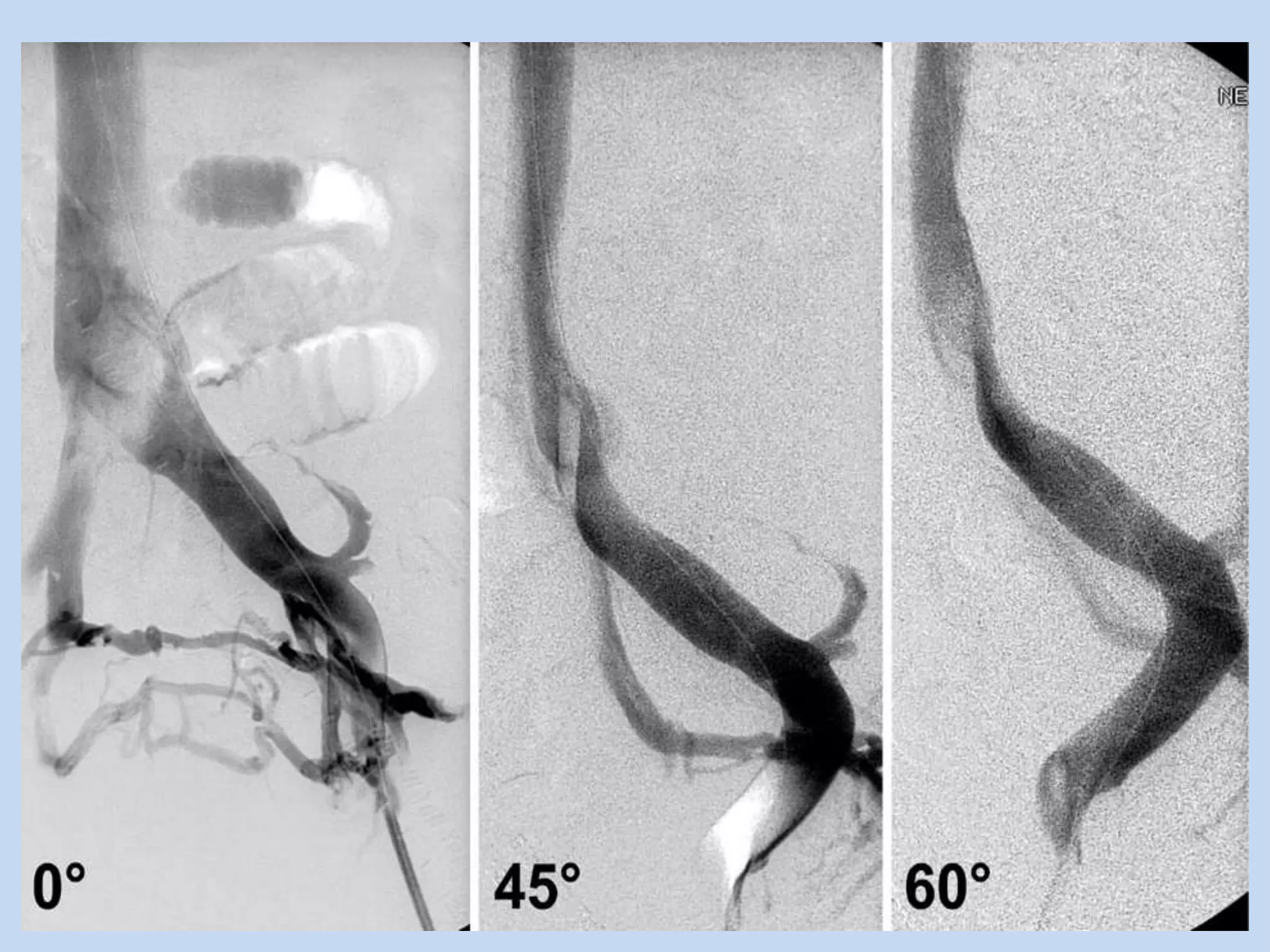 Non-Thrombotic Iliac Vein Lesions: Permissive Role in CVD Pathogenicity ...