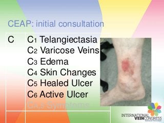 CEAP: The Key to the Initial Consultation