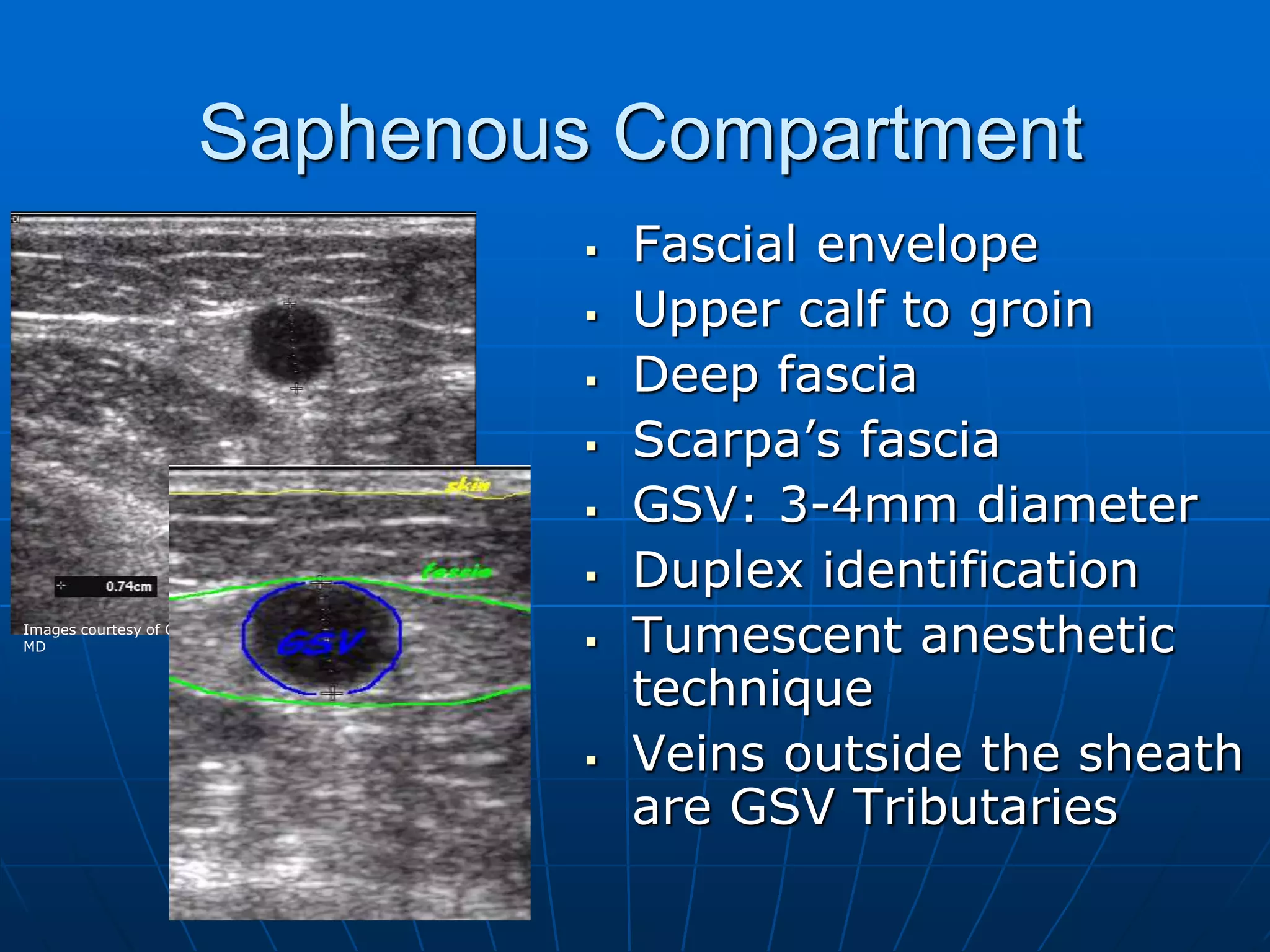The Great Saphenous Vein | PDF