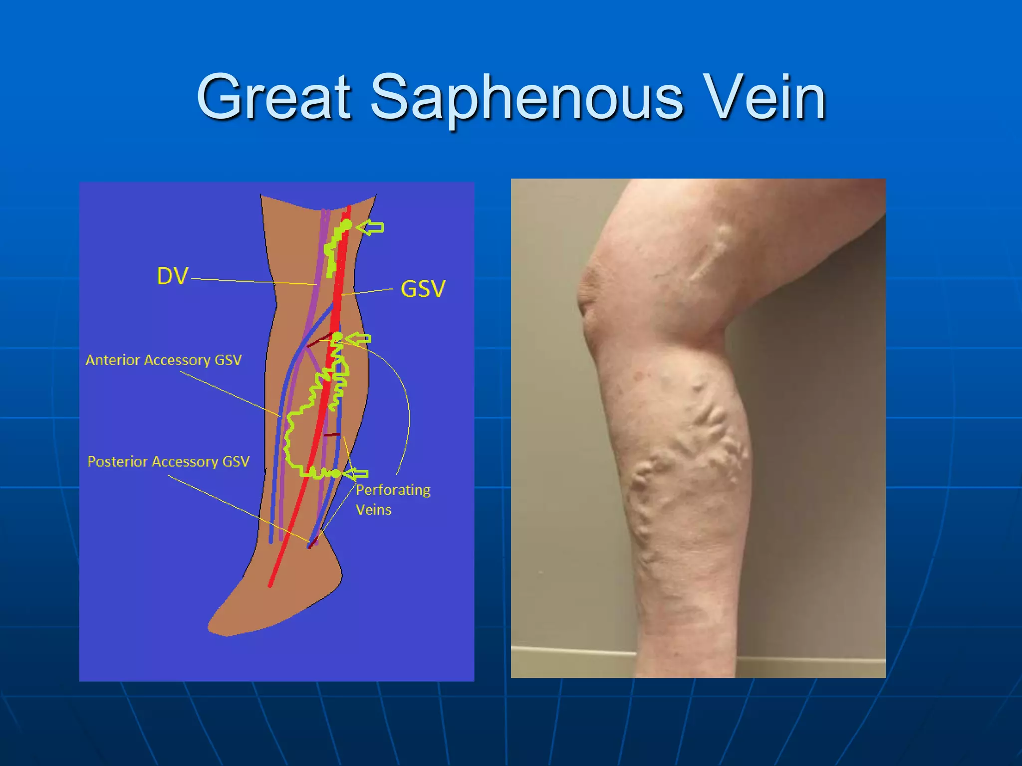 The Great Saphenous Vein | PDF