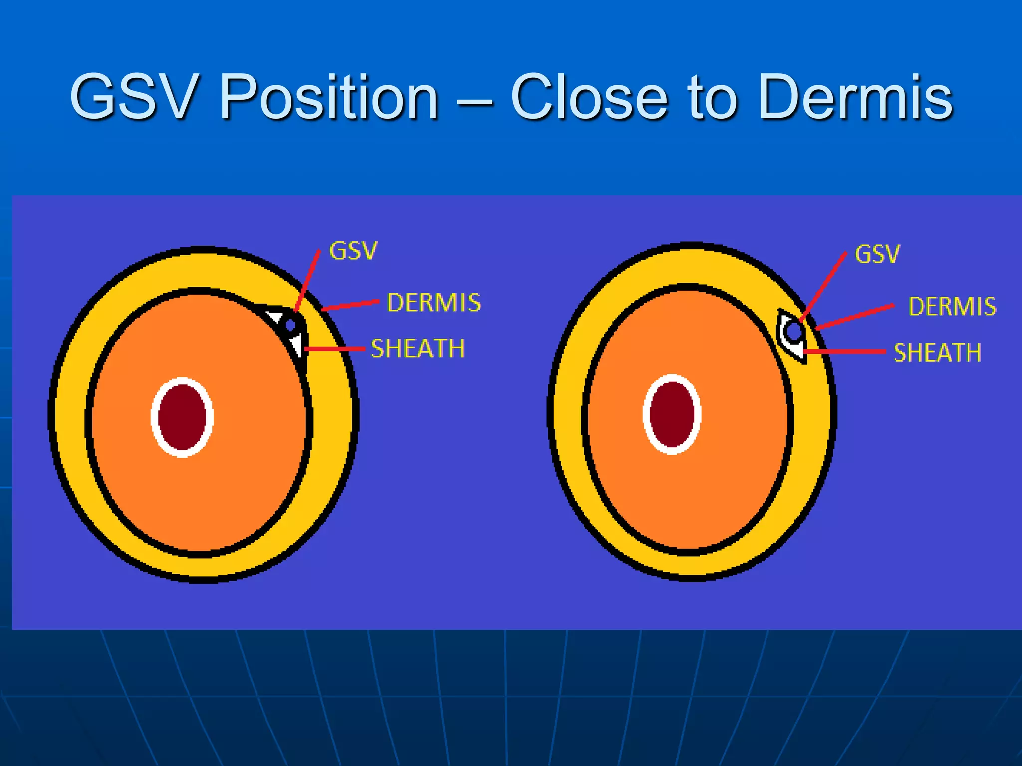 The Great Saphenous Vein | PDF
