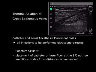 Great Saphenous Vein Thermal Ablation | PDF