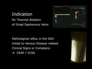 Great Saphenous Vein Thermal Ablation | PDF
