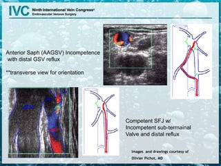 Duplex for Superficial Venous Disease | PDF