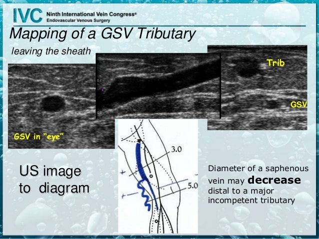 Duplex for Superficial Venous Disease