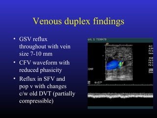 Who Needs More Testing Beyond Venous Duplex? | PPT