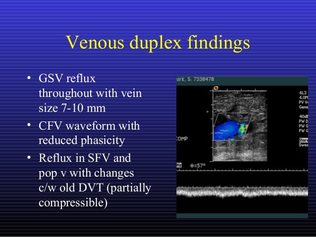 Venous reflux ultrasound - polkrealtime