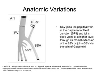 Small Saphenous Thermal Ablation | PDF