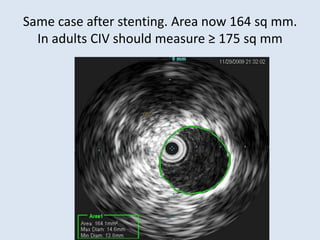 Pitfalls of IVUS Imaging | PPT
