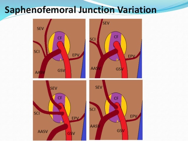 Does All Saphenous Reflux Need Ablation?