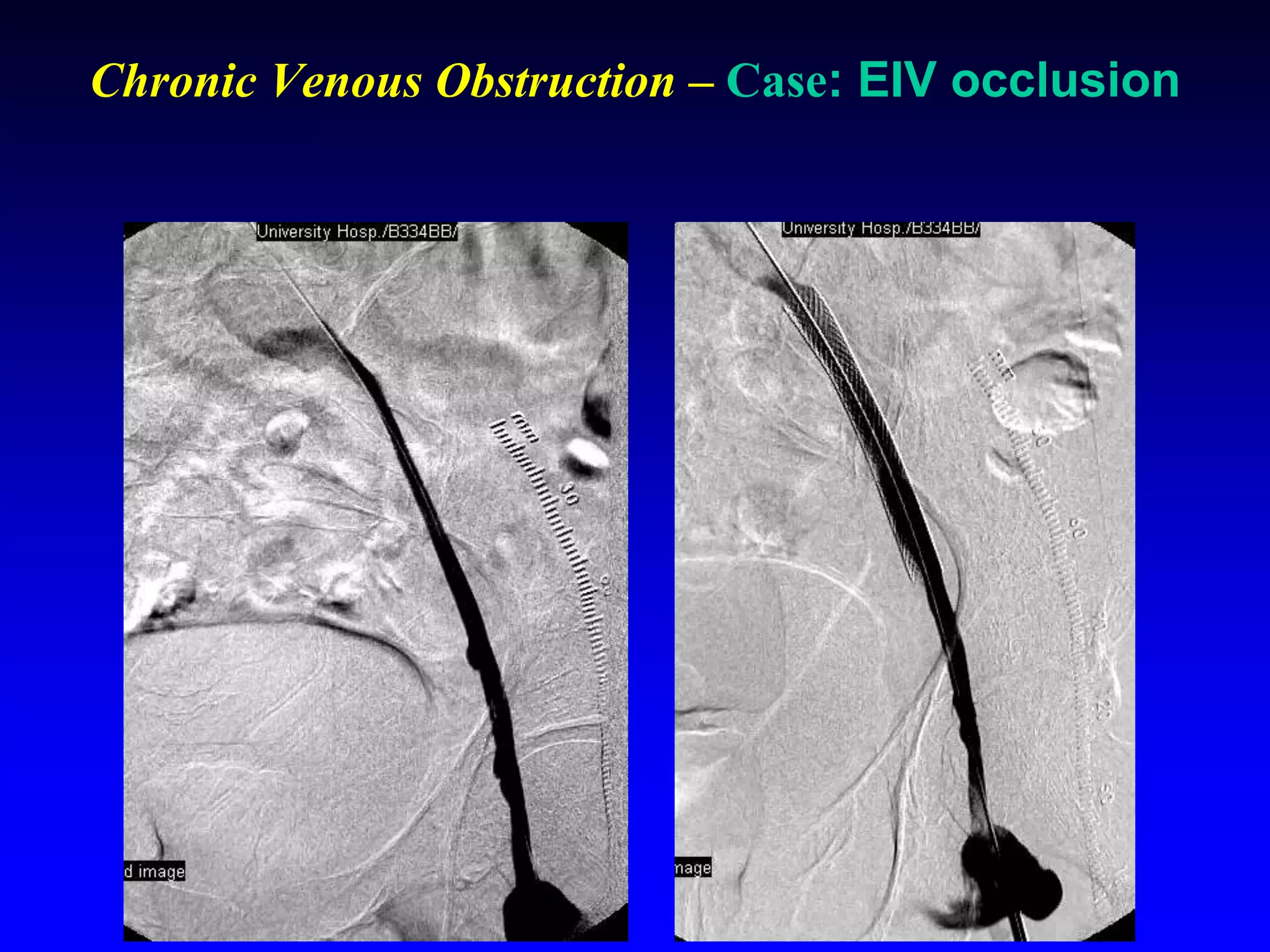 Deep Vein Pathophysiology: Reflux & Obstruction | PDF