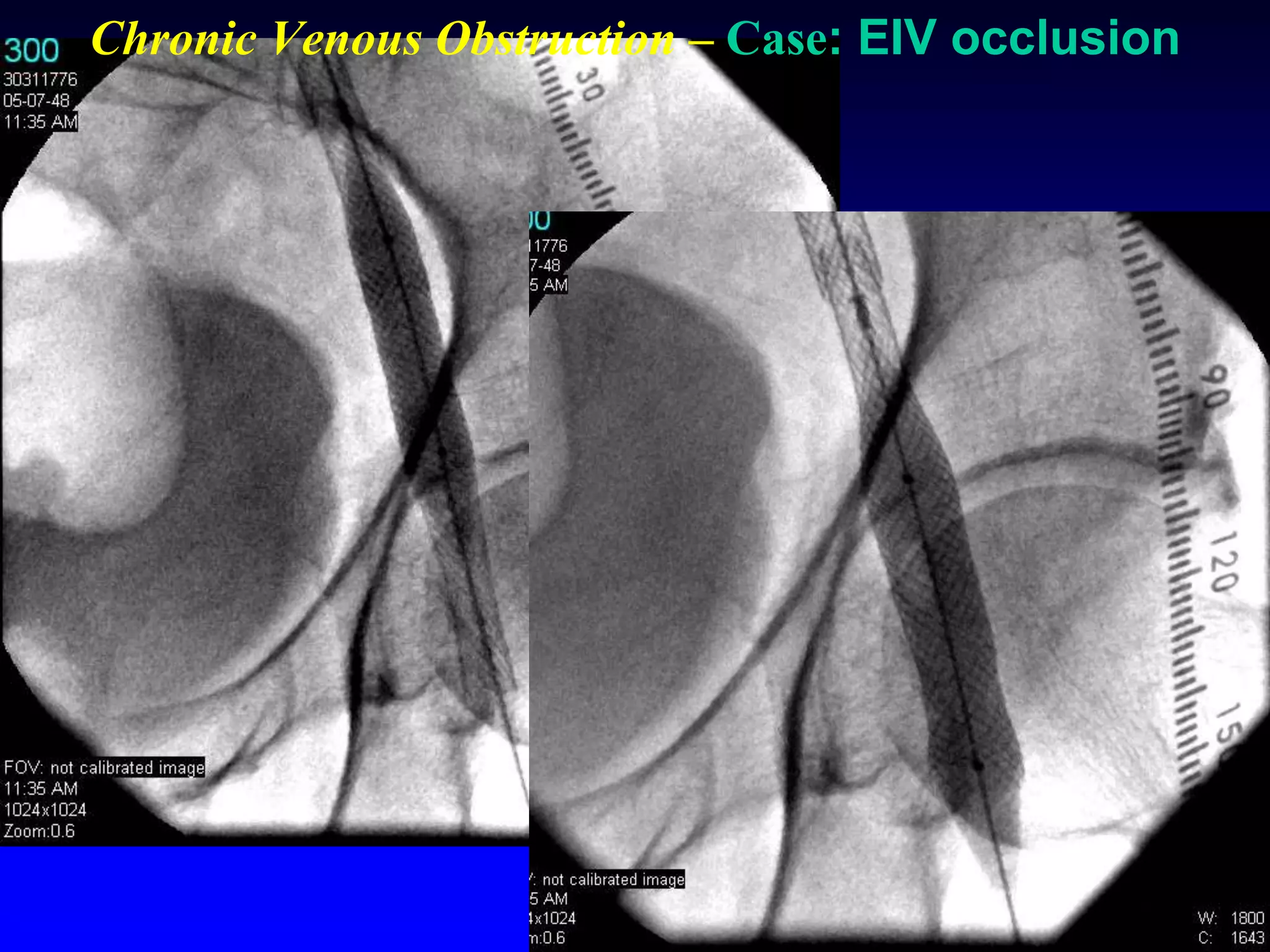 Deep Vein Pathophysiology: Reflux & Obstruction | PDF