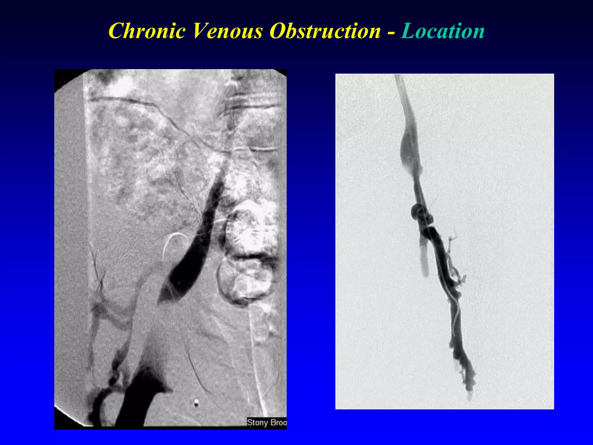 Deep Vein Pathophysiology: Reflux & Obstruction | PDF