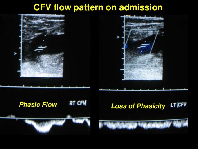 Deep Vein Pathophysiology: Reflux & Obstruction