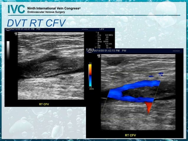 Detecting Deep Venous Disease with Duplex Ultrasound | PDF | Medical Health