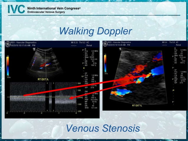 Detecting Deep Venous Disease with Duplex Ultrasound | PDF | Medical Health