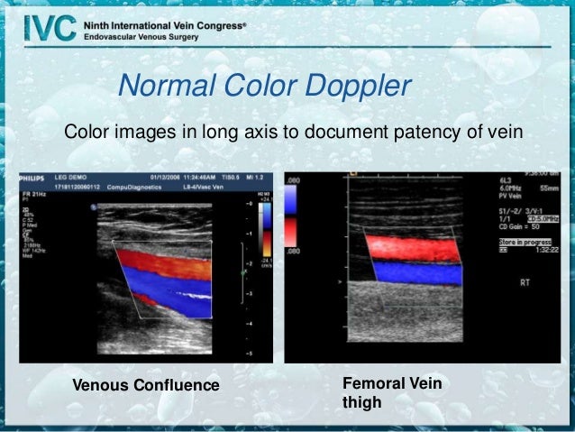 Detecting Deep Venous Disease with Duplex Ultrasound