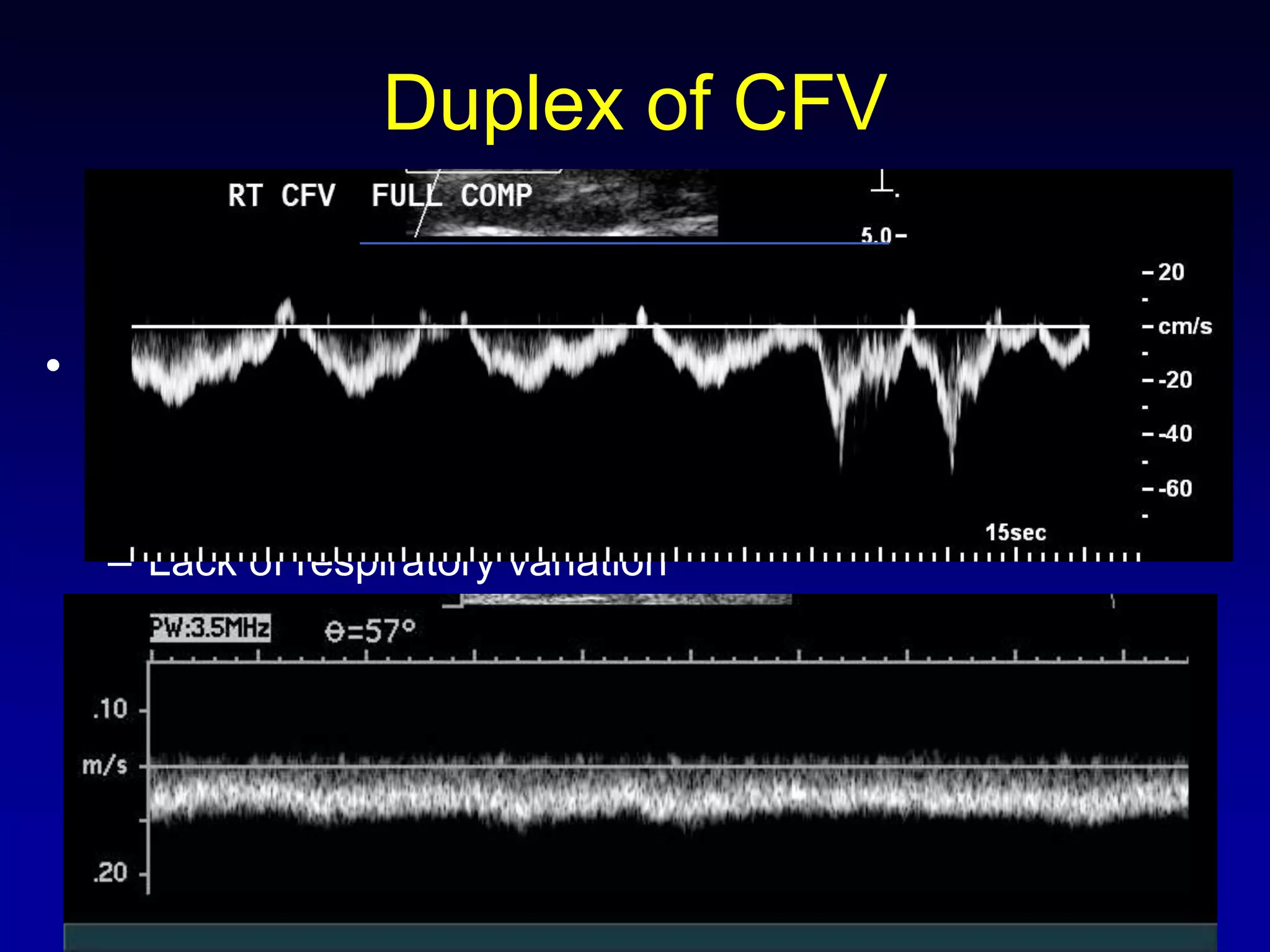Diagnosis of Llio-caval Venous Obstruction: Causes of Venous ...