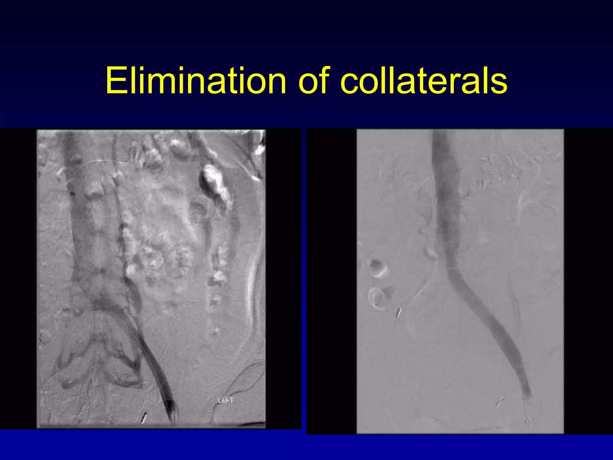 Diagnosis of Llio-caval Venous Obstruction: Causes of Venous ...