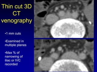 Diagnosis of Llio-caval Venous Obstruction: Causes of Venous ...