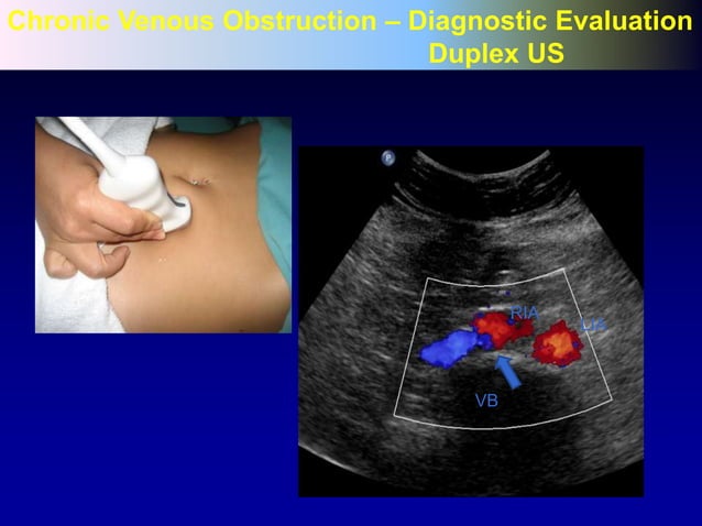 Diagnosis of Llio-caval Venous Obstruction: Causes of Venous ...