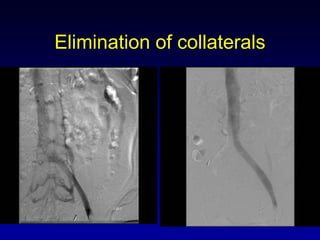 Diagnosis of Llio-caval Venous Obstruction: Causes of Venous ...