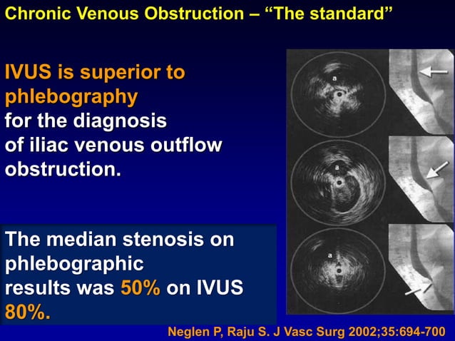 Diagnosis of Llio-caval Venous Obstruction: Causes of Venous ...