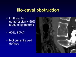 Diagnosis of Llio-caval Venous Obstruction: Causes of Venous ...