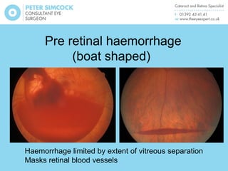 A macular pathology and oct update for optometrists | PPT