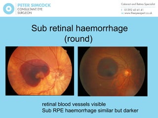 Sub Rpe Hemorrhage