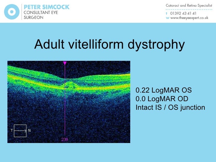 A macular pathology and oct update for optometrists