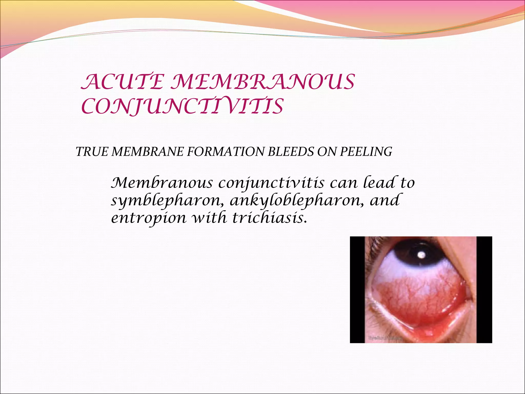 diseases of the conjuntiva | PPT