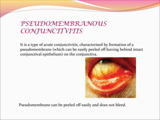diseases of the conjuntiva | PPT