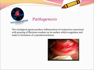 diseases of the conjuntiva | PPT