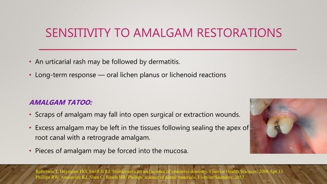 Amalgam | PPTX | Dental Health | Diseases and Conditions