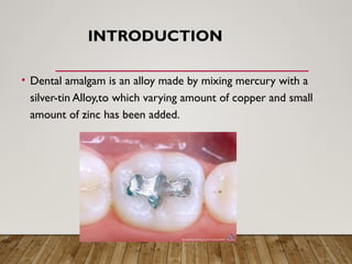 Amalgam and its uses in dental setting.pptx