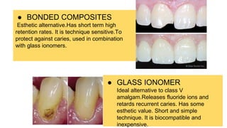 Amalgam alternatives | PPTX | Oral care | Personal Care